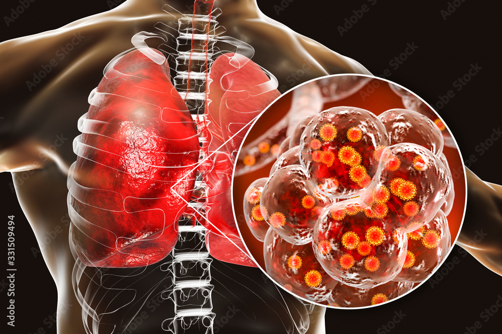 SARS-CoV-2 viruses in alveoli of human lungs causing COVID-19. Novel Coronavirus Stock ...