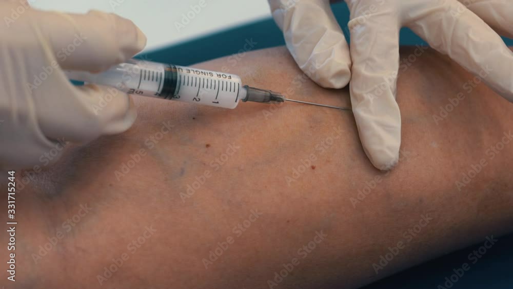 Treatment of varicose veins with injections. An injection into a vein ...