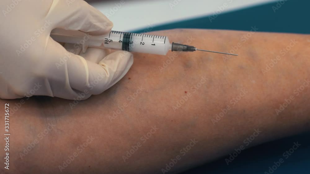 Treatment of varicose veins with injections. An injection into a vein ...