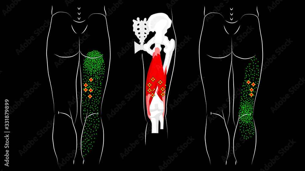 Trigger points and reflected pain in the hamstring muscles. Stock ...