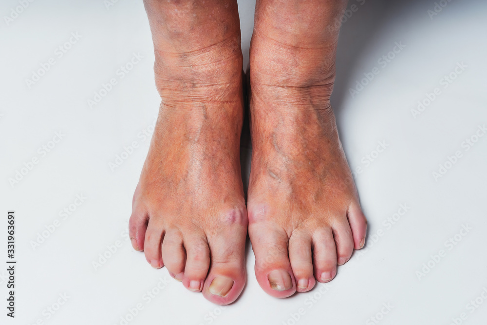 Varicose veins on the feet of an elderly woman. Inflamed dilated veins ...