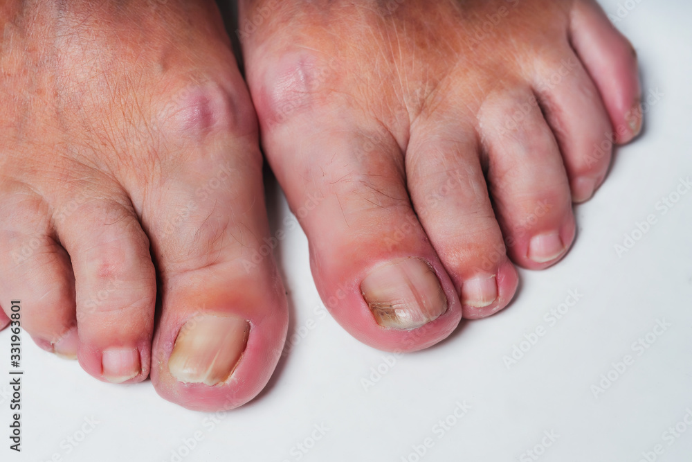 Nail fungus on the toes of an elderly woman's feet close-up on a white ...