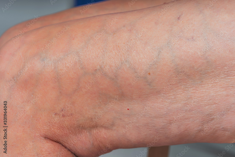 Varicose veins in an elderly woman. Inflamed dilated veins in the legs ...