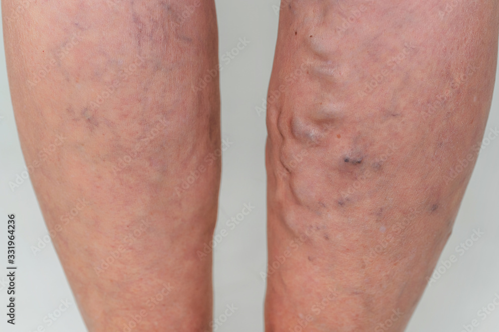 Varicose veins in an elderly woman. Inflamed dilated veins in the legs ...