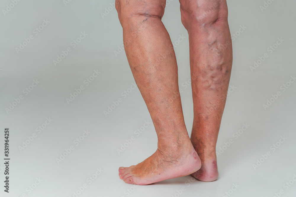 Varicose veins in an elderly woman. Inflamed dilated veins in the legs ...