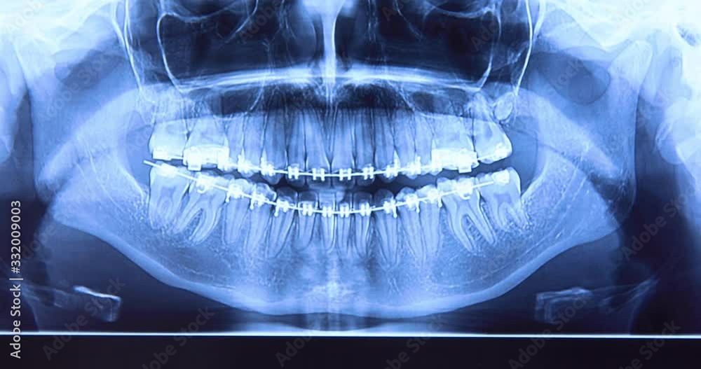 Dental x-ray with braces. Radiography for teeth straightening and ...