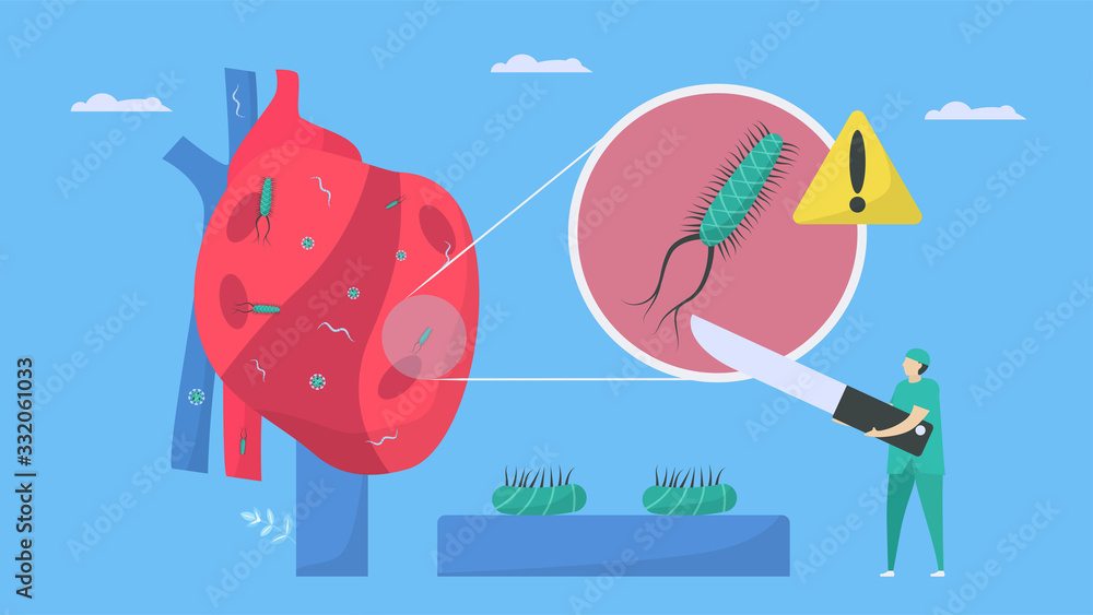 Cardiology treatment by surgeon. This disease calls endocarditis. It is ...