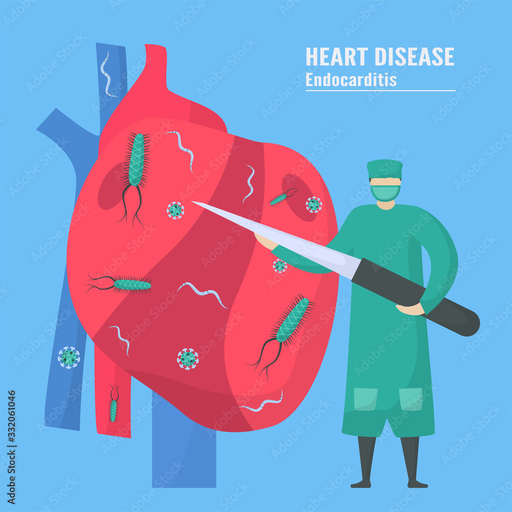 Cardiology treatment. This disease calls endocarditis. It is infection ...