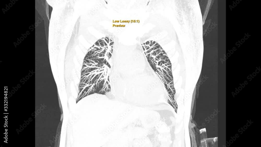 CT Chest or CT Scan of Human Chest Lung filter technique Coronal MIP View for diagnosis TB ...