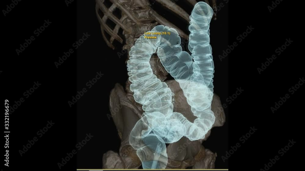 CT colonography or CT Scan of Colon 3D Rendering image with transparent ...
