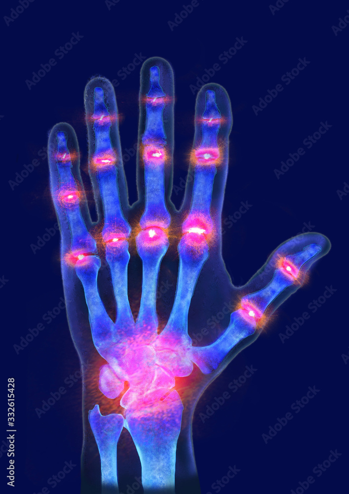 Hand, Gicht, Schmerzzonen, Computertomographie, Illustration Stock ...