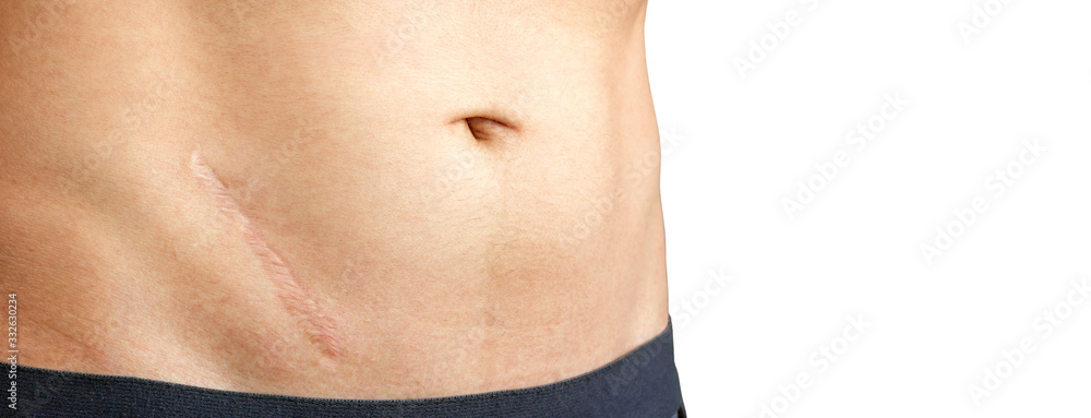 Scar on abdomen after removal of appendicitis. Banner with copy space ...