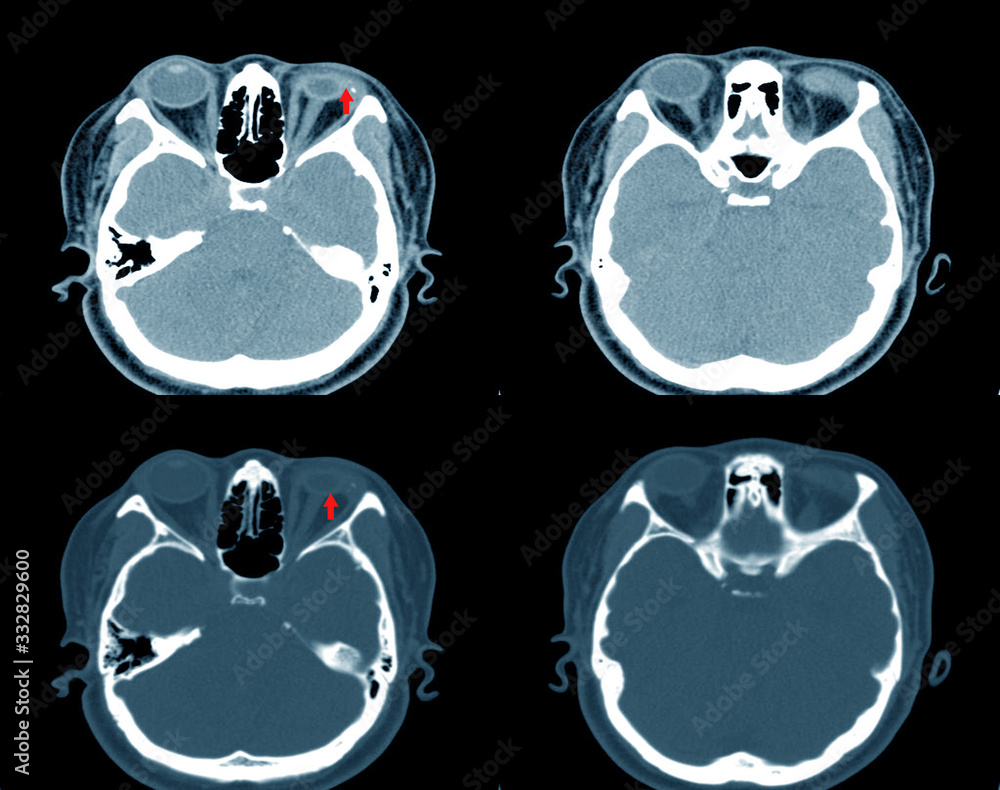 CT-Scan brain and orbit Impression: Rupture of Lt eye globe with ...