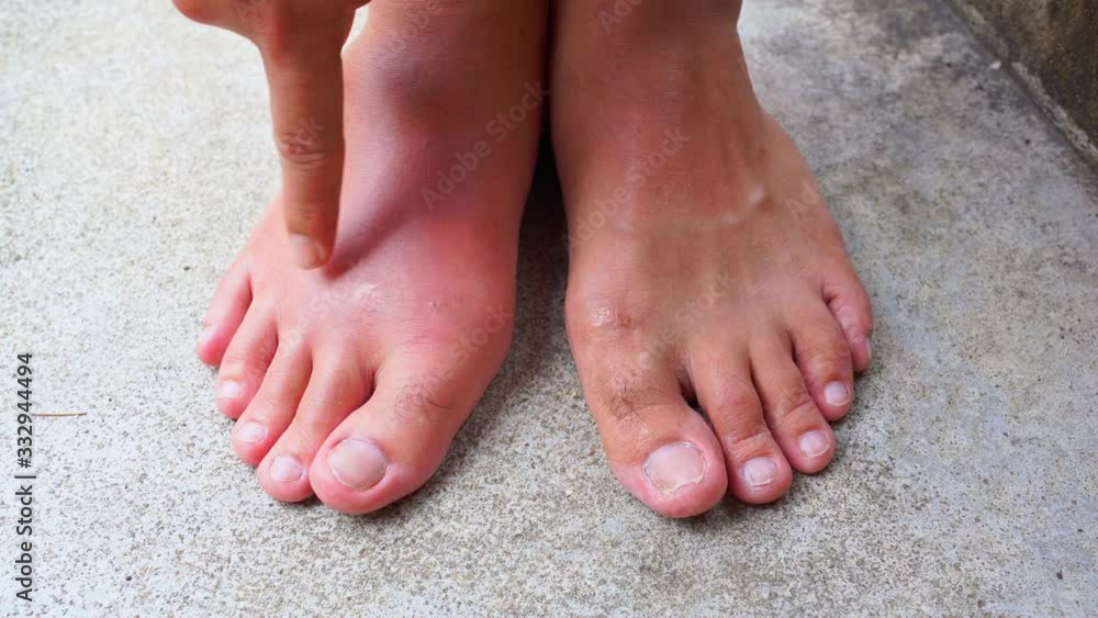 Close up old man right foot, Ankle wounded waiting and swelling ...