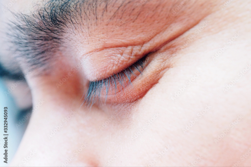 Closeup of deep crow's feet of Asian male with skin texture and ...