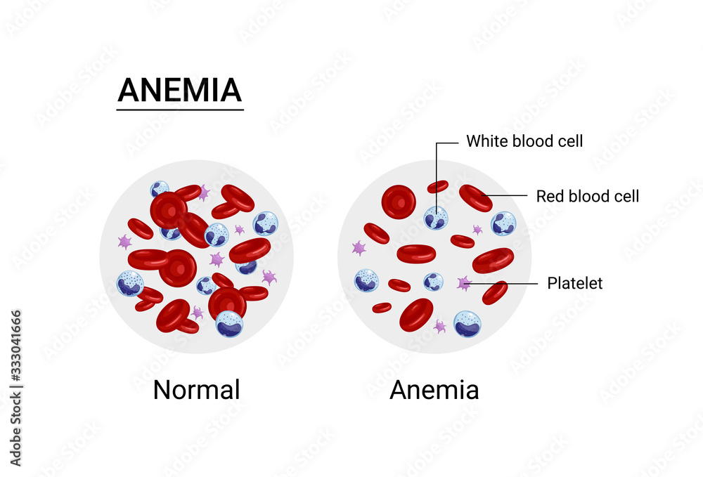 Vector illustration of anemia and normal amount of red blood cells ...