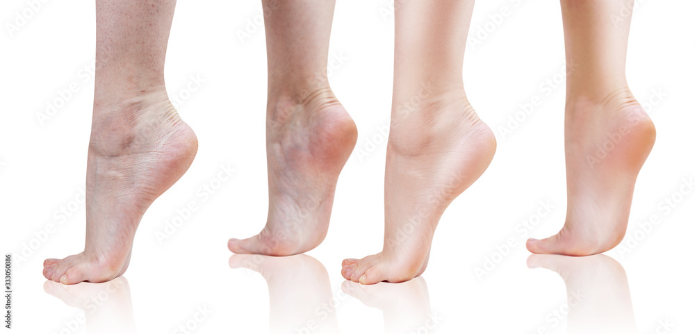 Female feet with dry skin before and after treatment or retouch. Stock ...