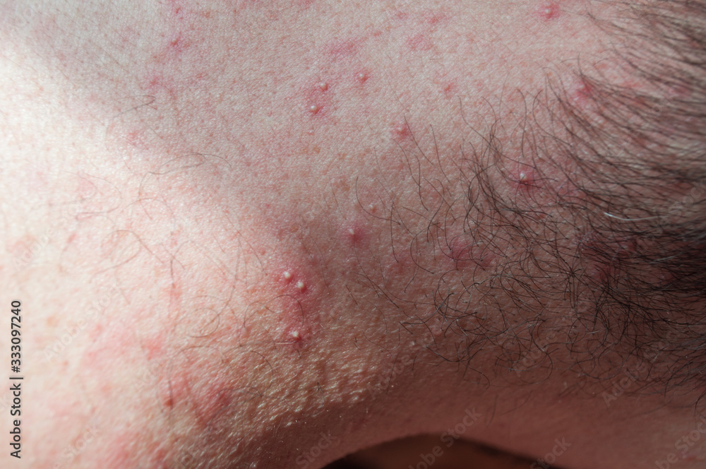 Purulent rashes on the neck of a man. Allergy, acne. Skin diseases ...
