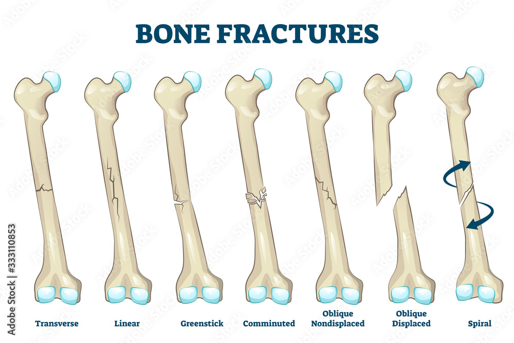 Bone fractures vector illustration Stock Vector | Adobe Stock
