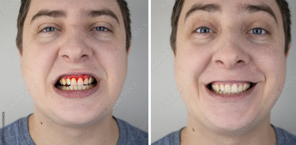 A man has gum bleeding. Photos before and after treatment of ...