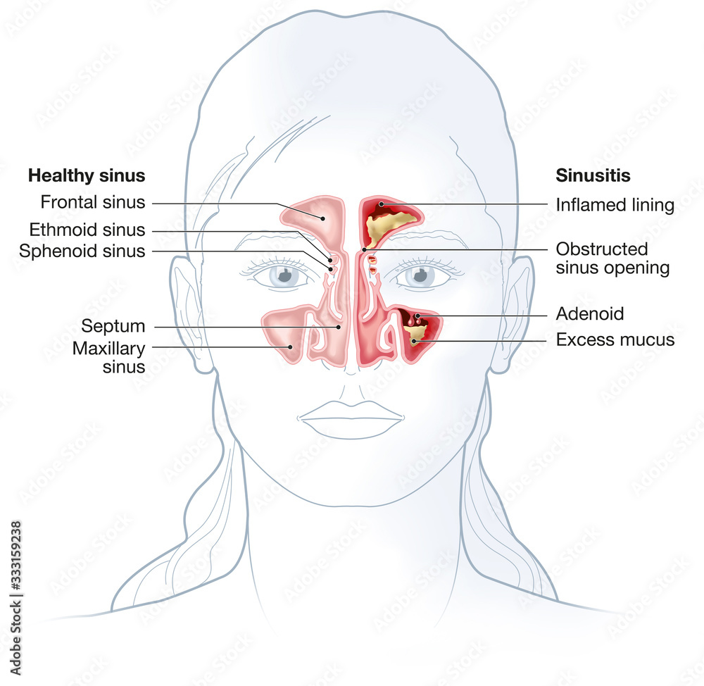 Healthy sinus and sinusitis, medical illustration, labeled Stock ...