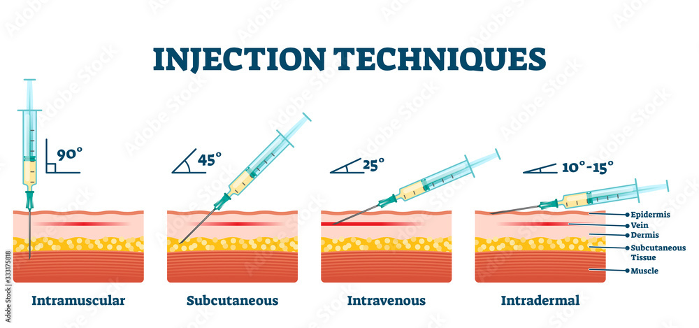 Injection techniques vector illustration. Medical procedure examples ...