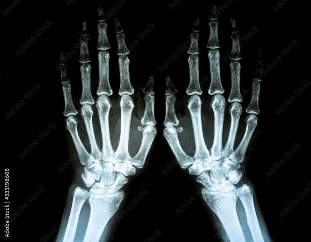 Film X-ray of Rheumatoid arthritis hand shows joint space narrowing of ...