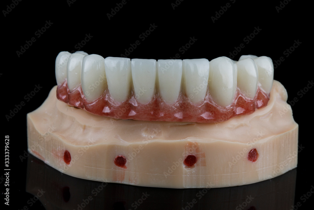 temporary dental prosthesis of the lower jaw with a pink gum on a model ...