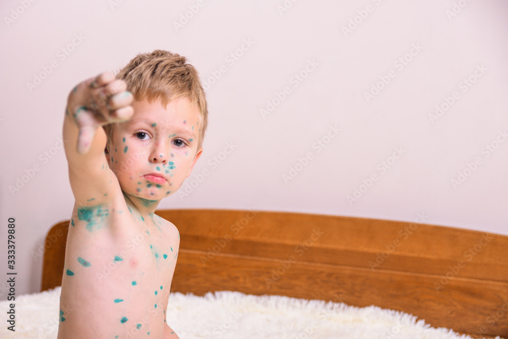 Young toddler,boy with chickenpox. Sick child with chickenpox ...