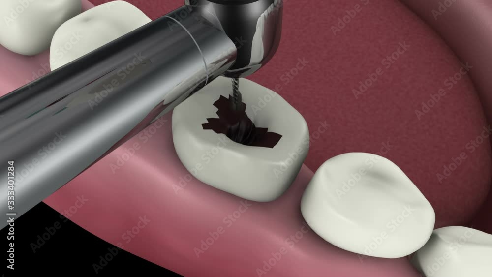 Biomedical animation of a root canal treatment. Stock Video | Adobe Stock