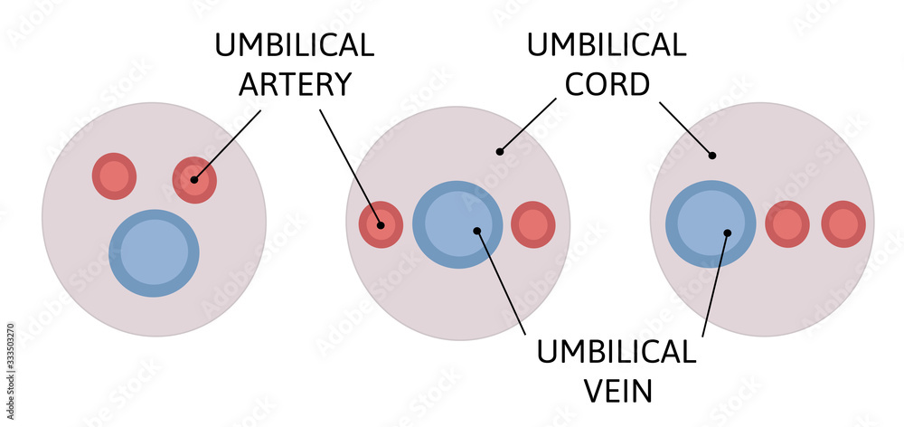 Mutual position of the umbilical cord vessels Stock Vector | Adobe Stock