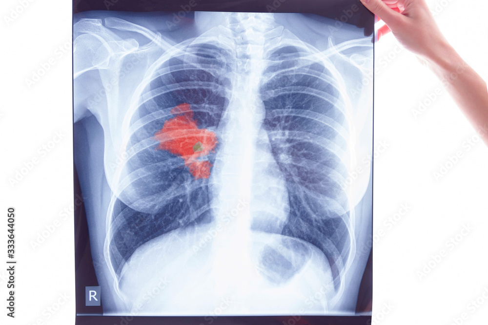 Closeup x ray snapshot of lungs that shows affect from virus SARS-CoV-2 ...