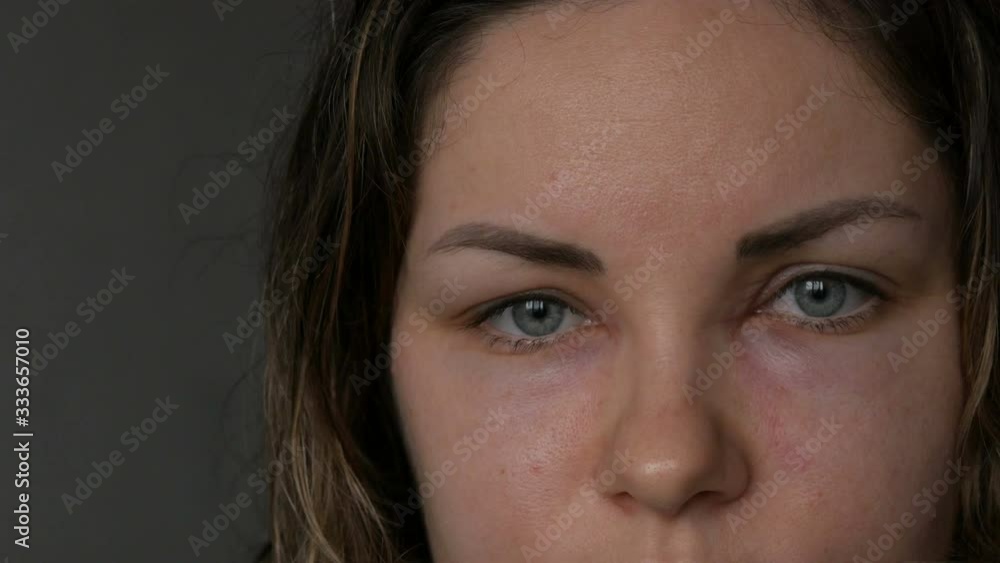 Young girl with an allergic reaction on the face and eyes, Quincke's ...