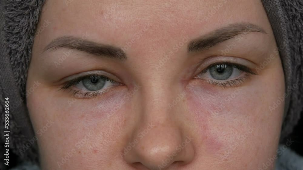 Young girl with an allergic reaction on the face and eyes, Quincke's ...