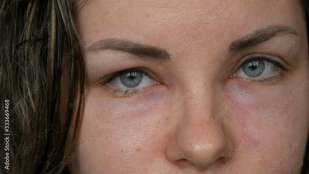 Young girl with an allergic reaction on the face and eyes, Quincke's ...