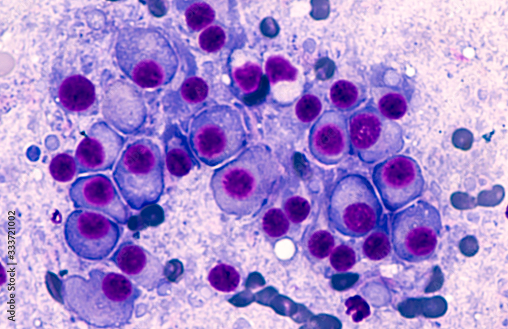 Multiple Myeloma Awareness: Bone marrow aspirate cytology of multiple ...