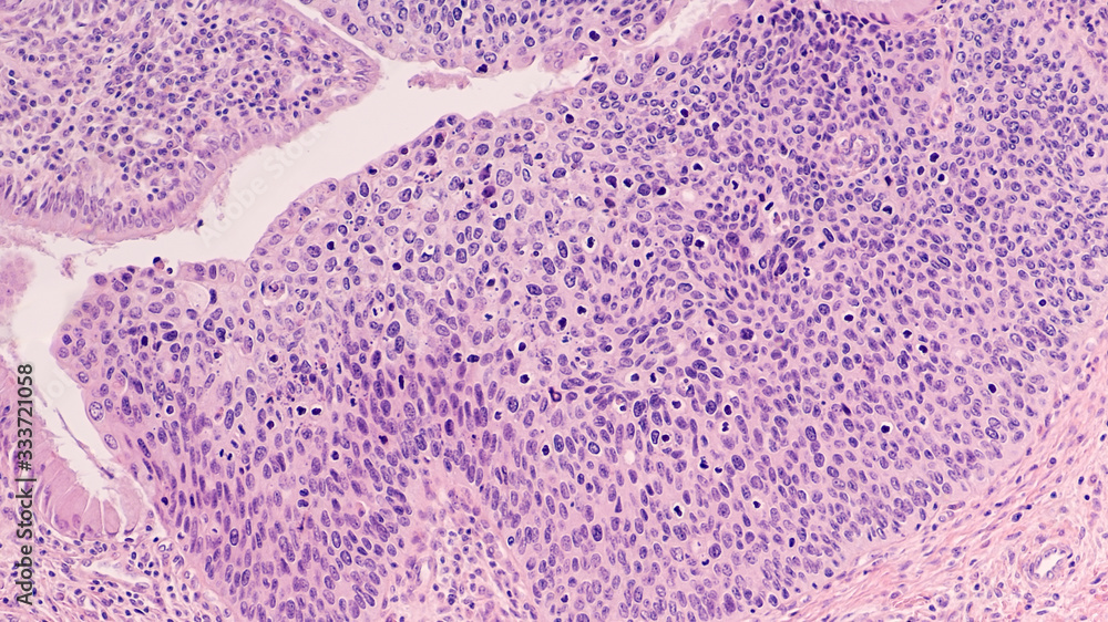 Severe Dysplasia (CIN IiI, HSIL), related to human papilloma virus (HPV ...