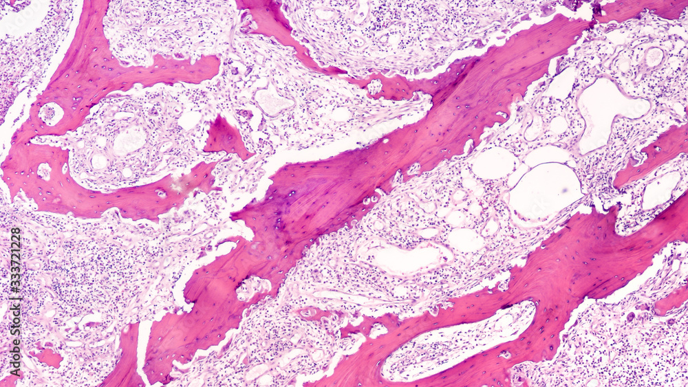 Diabetes Awareness: Photomicrograph showing osteomyelitis, with ...