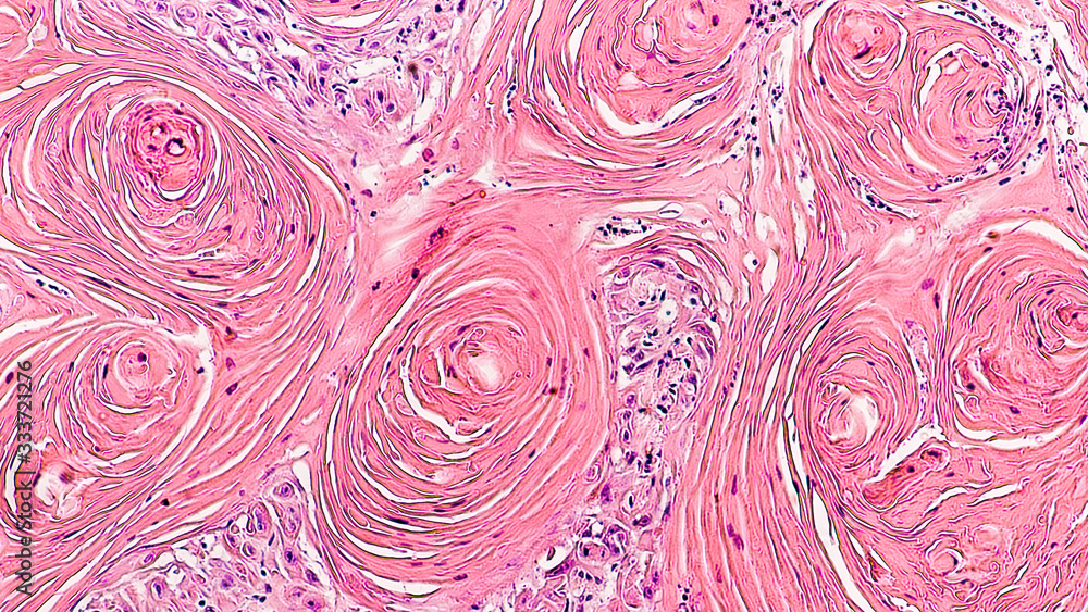 Microscopic image of skin biopsy of invasive squamous cell carcinoma ...