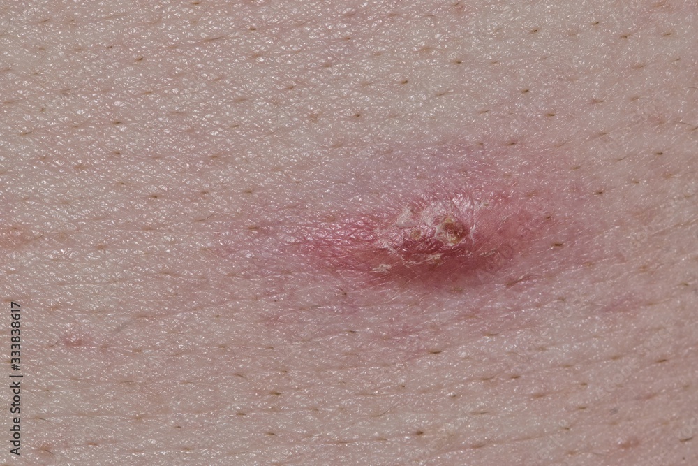 Acne pimple on Caucasian skin beginning to scab and heal over. Macro ...