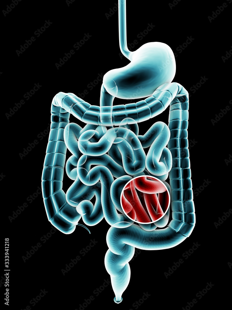 anatomy of human digestive system model with inflammation section Stock ...