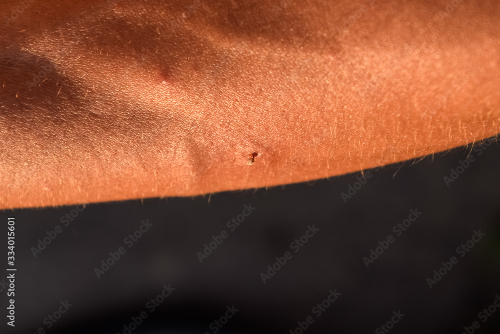 Bee sting. Bee sting in human skin. consequences of stinging with bee ...