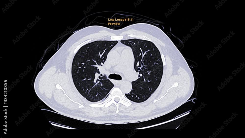 CT Chest or HRCT Axial View with high resolution Lung filter technique ...