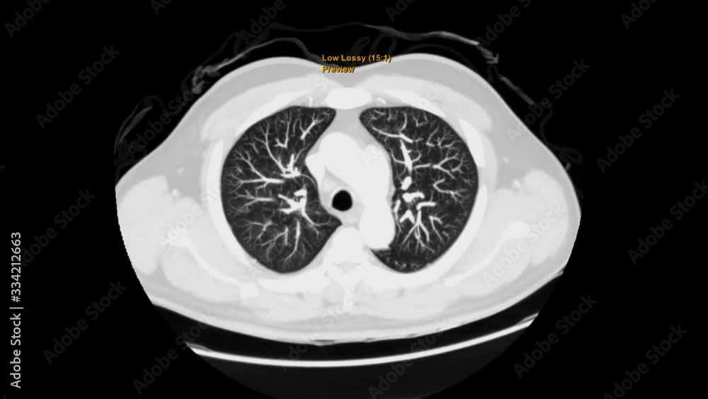 CT Chest or CT Scan of Human Chest Coronal MIP View with Lung filter technique for diagnosis TB ...