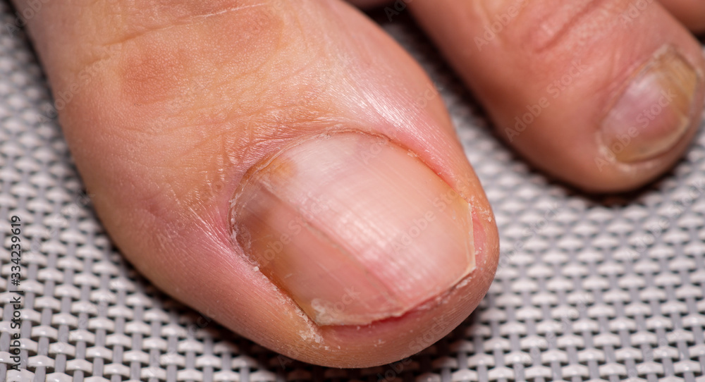 Nail infections caused by fungi such as: onychomycosis caused by ...