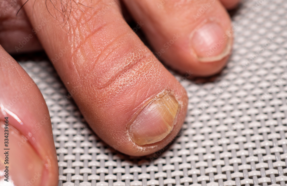 Nail infections caused by fungi such as: onychomycosis caused by ...