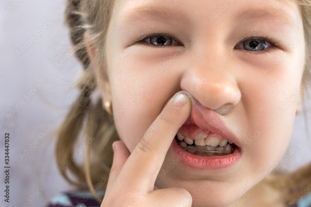 Adult permanent teeth coming in front of the child's baby teeth: shark ...