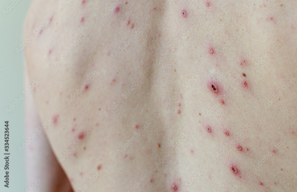 Large spots and pimples acne on the body - adult body with chickenpox ...