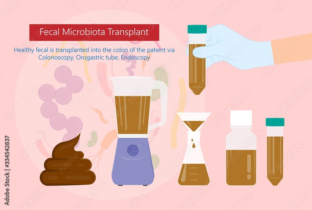 Fecal microbiota transplant (FMT) stool transferring bacteria microbes ...
