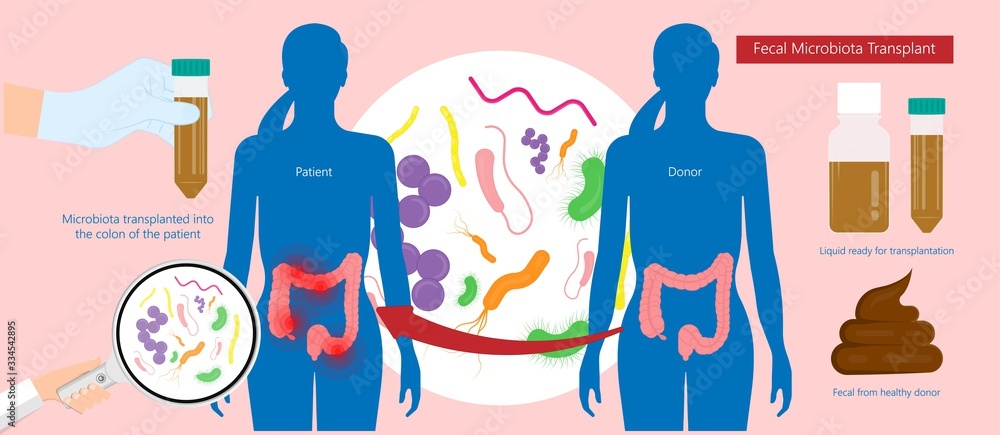 Fecal microbiota transplant (FMT) stool transferring bacteria microbes ...